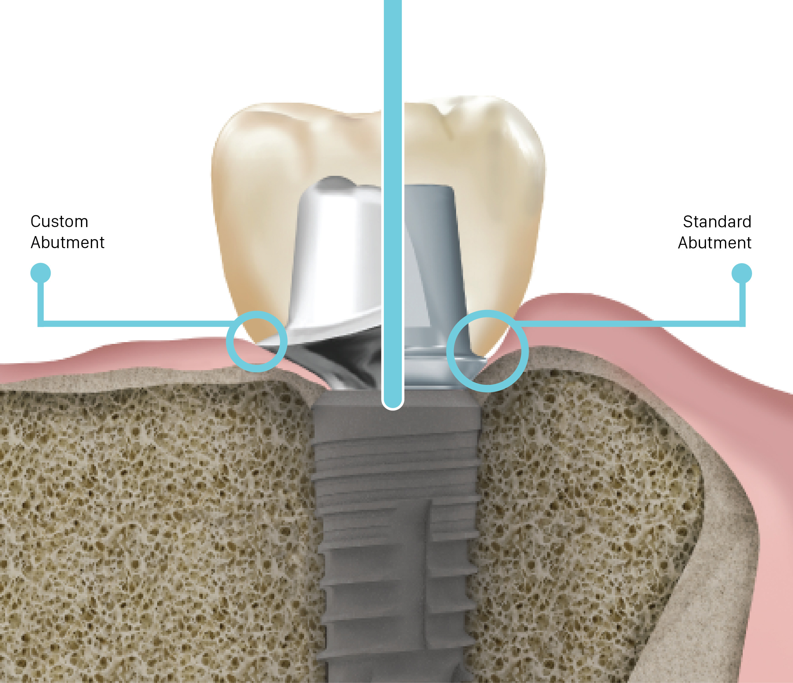 Implant an toàn là gì? - Nha Khoa Blossom - Nha khoa thẩm mỹ hàng đầu ...