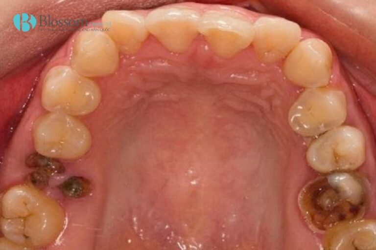 Răng sâu chỉ còn chân răng phải làm sao? Lời khuyên từ nha sĩ về giải ...