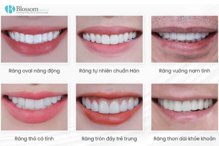 Dáng răng sứ đẹp – 10 mẫu được ưa chuộng và cách chọn chuẩn nhất